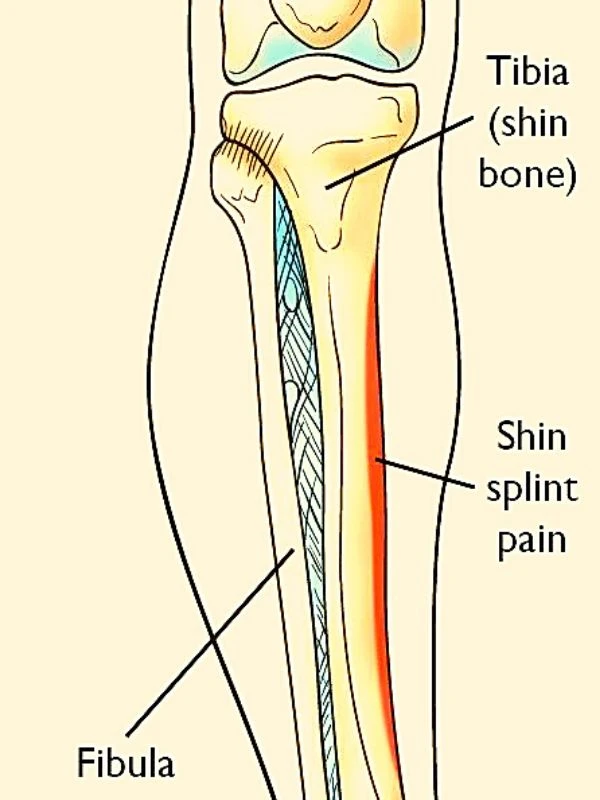 Shin splints | Causes, Symptoms, Treatment and Preventions