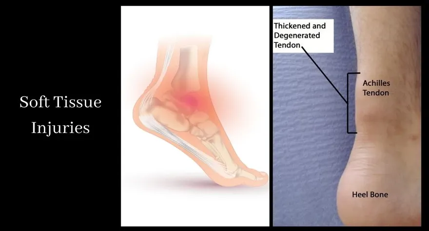 Understanding Soft Tissue Injuries & their symptoms