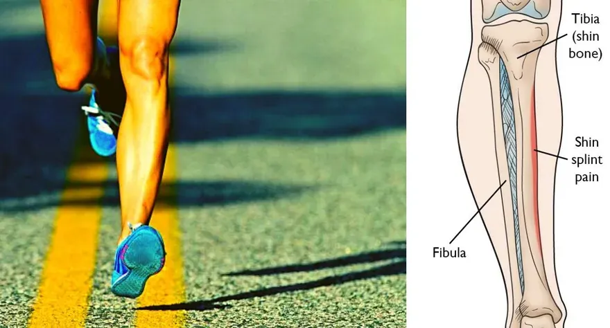Shin splints | Causes, Symptoms, Treatment and Preventions